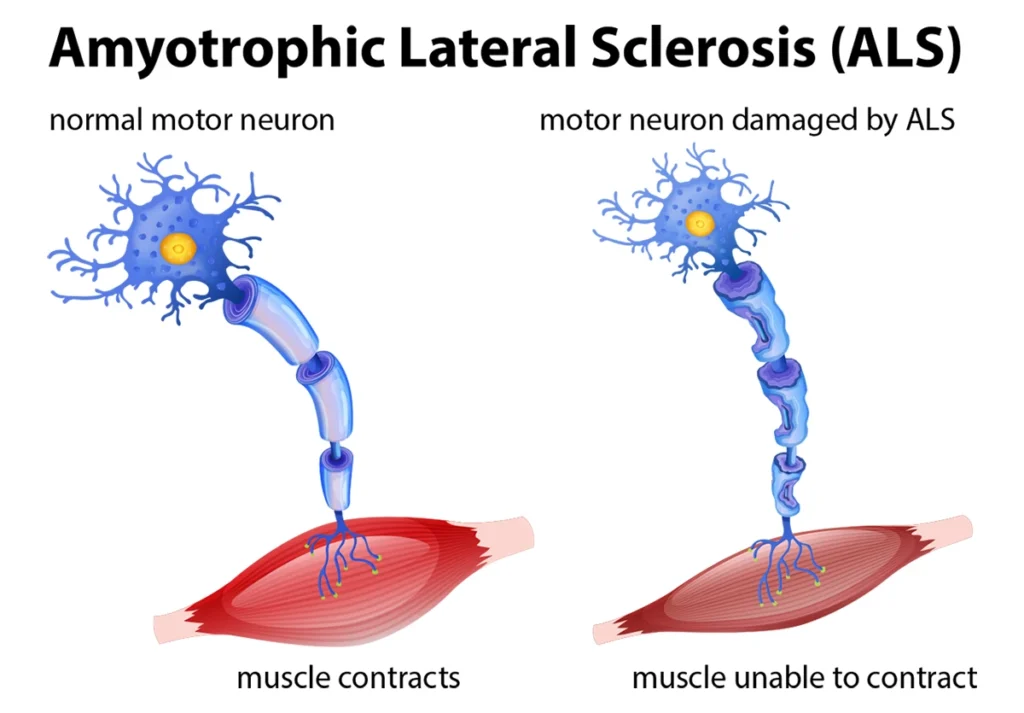 Understanding ALS: Causes, Symptoms, and Breakthrough Treatments in ...