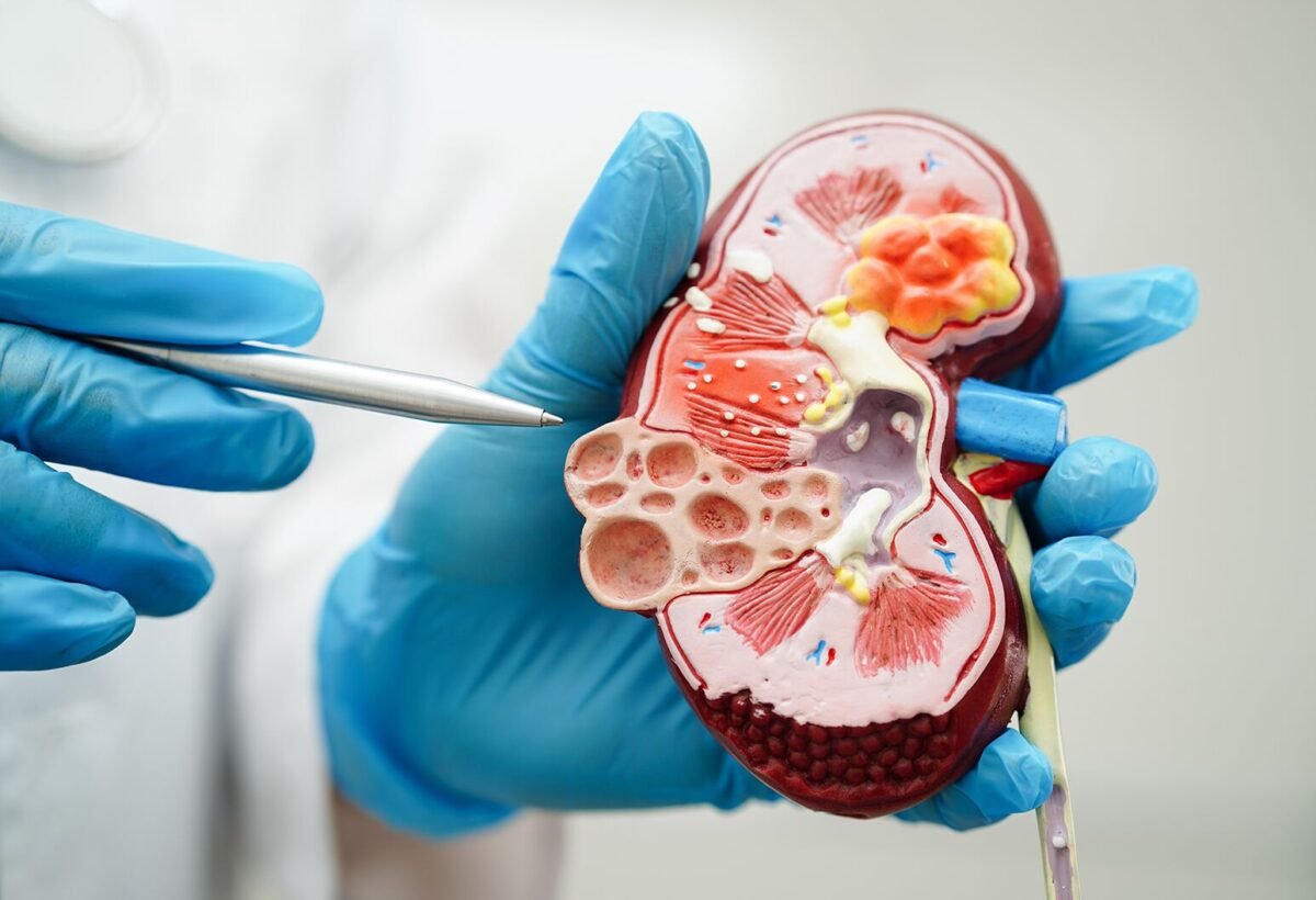 Kidney Disease Explained: Early Signs, Treatment & Lifestyle Changes ...