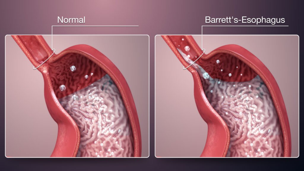 Barrett’s Esophagus: Causes, Risks, and Treatment Guide – RevisionTown